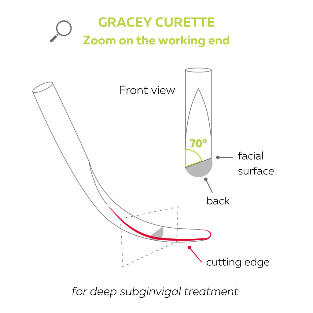 Periodontal curettes: focus on Gracey curettes • Dental hand instruments
